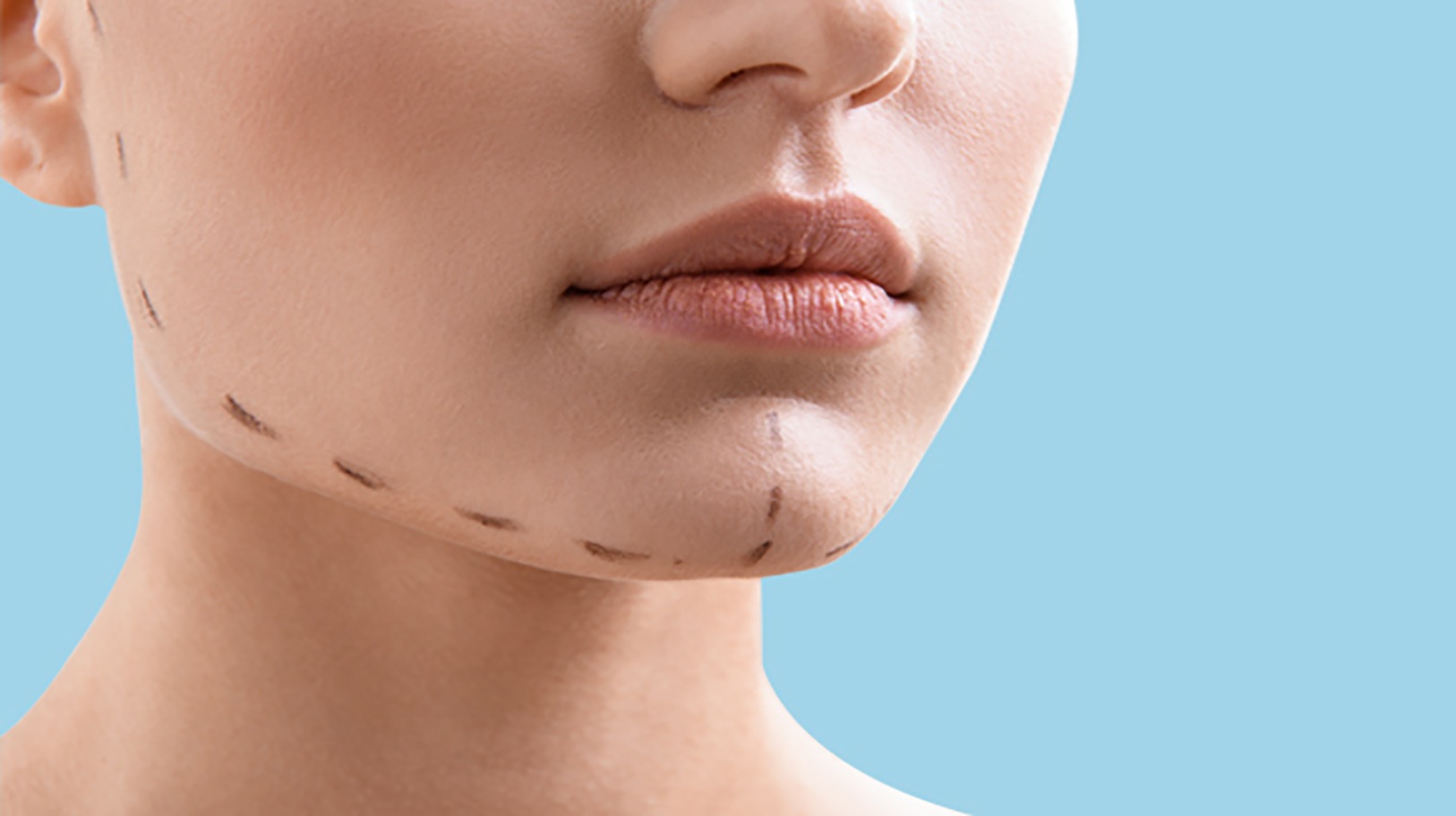 Mejora tu perfil con mentoplastia | Clínica Páramo