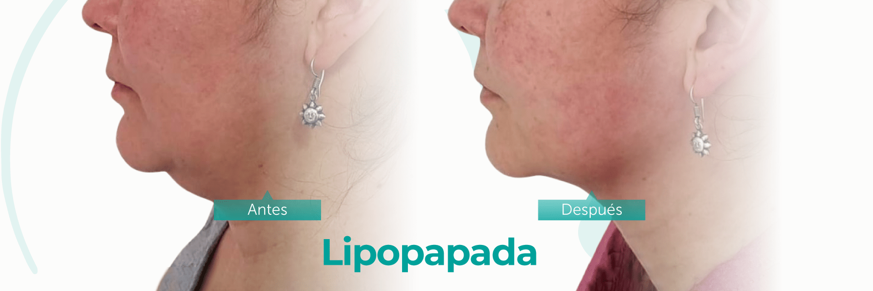 Bichectomía y Lipopapada en Clínica Páramo | Clínica Páramo